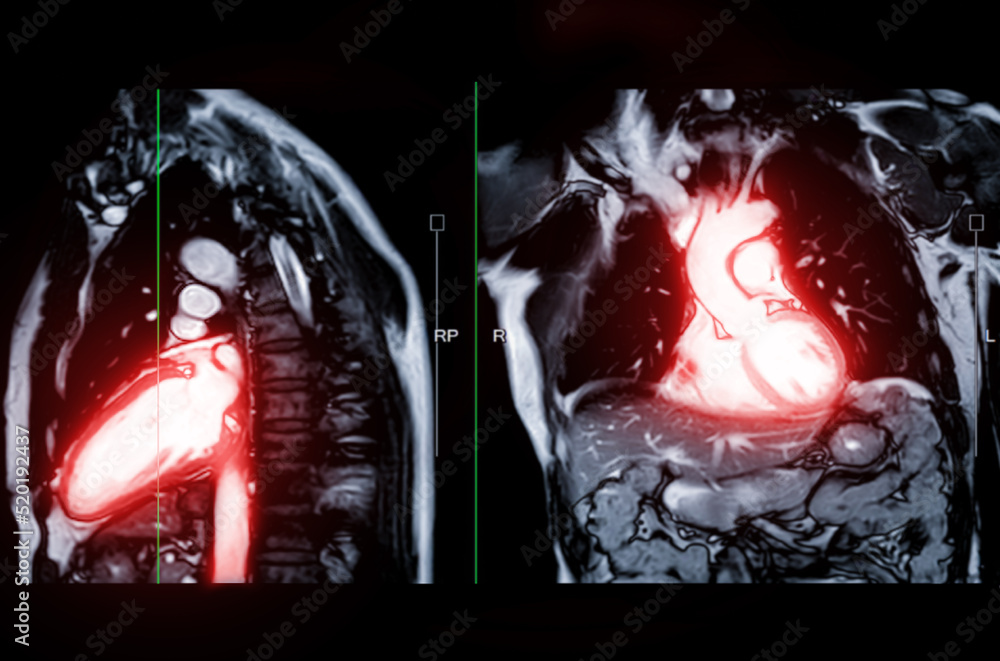 MRI heart or Cardiac MRI . Stock Photo | Adobe Stock