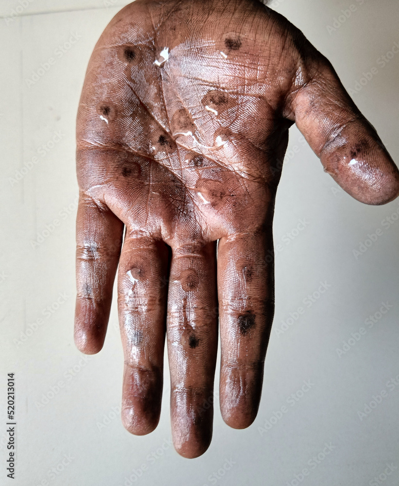 Monkey pox virus transmitted in human body starting symptoms Stock ...