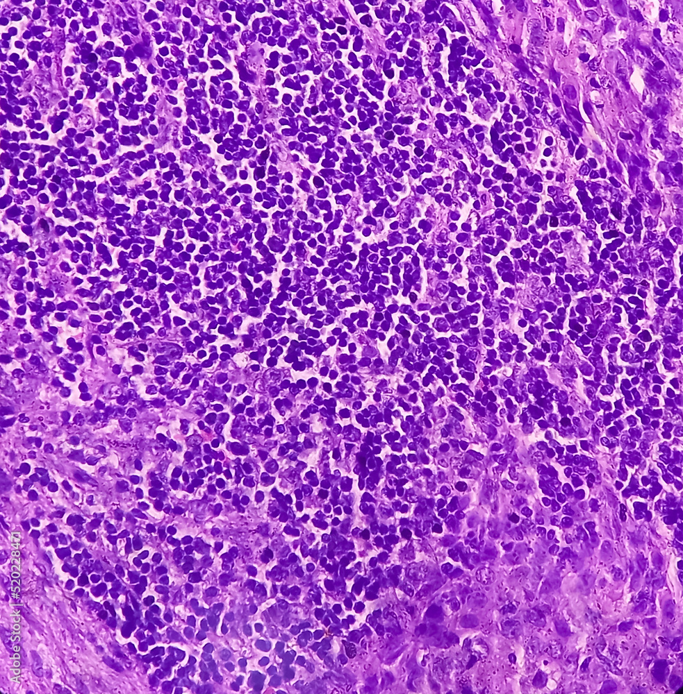 Infected pre auricular lymph node(biopsy): Warthin Tumor, show lymph ...