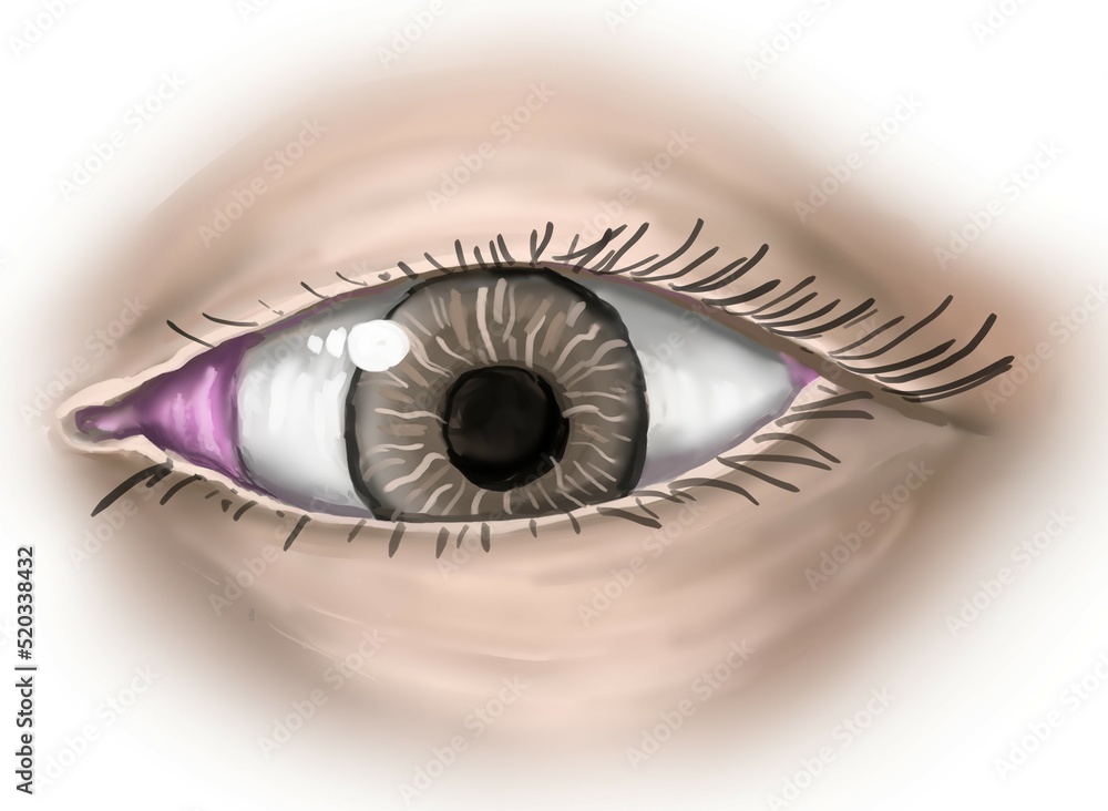 the upside down ptosis is the up rise of lower eye lid caused by ...