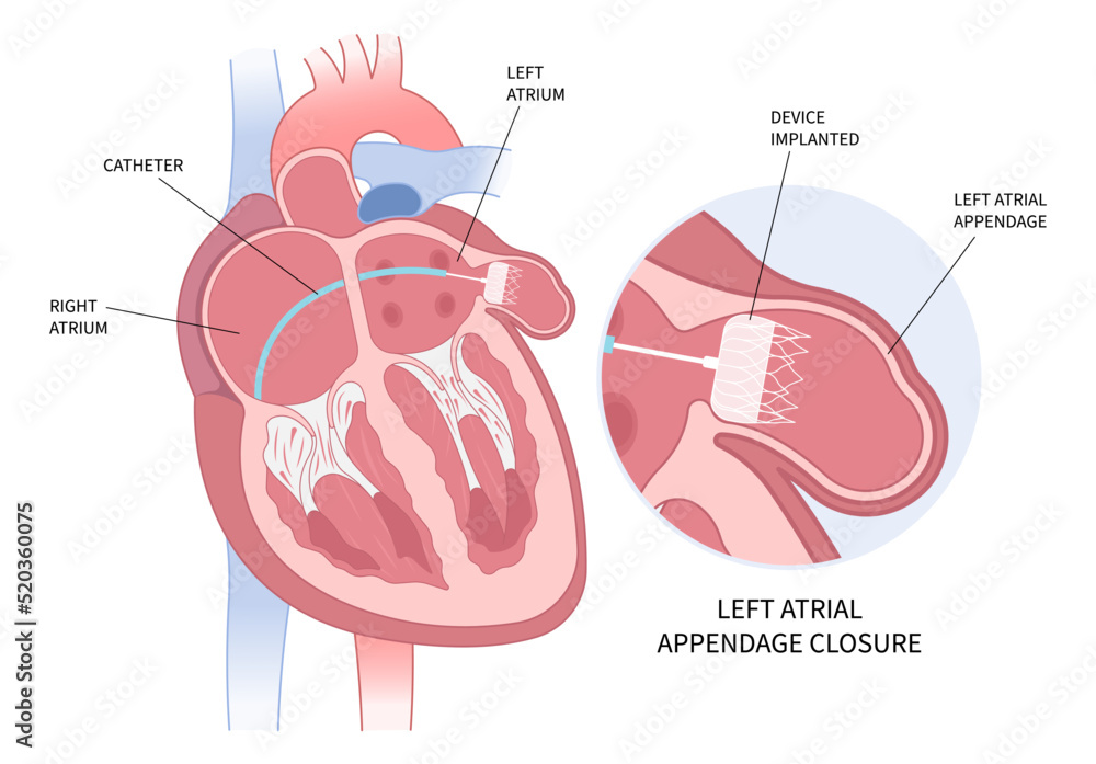 Left arterial appendage closure device implant to heart for treatment ...