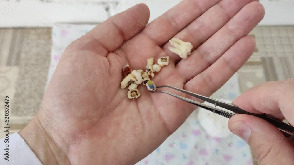 Dentist holds and shows many extracted teeth in the palm of his hand ...