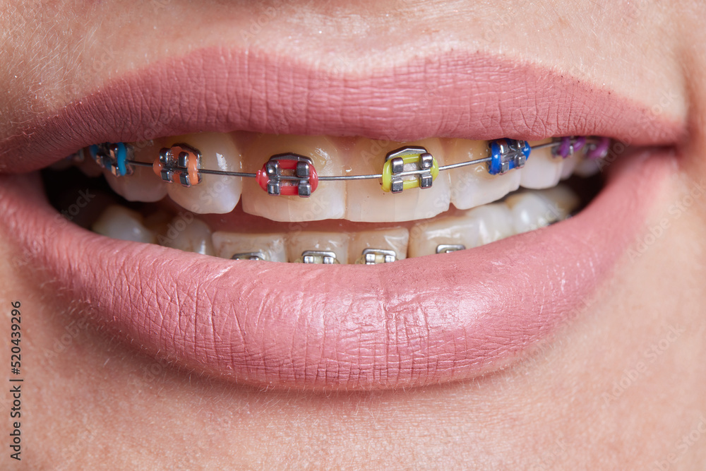 Dental procedure for installing braces close up.The procedure for the ...