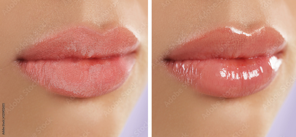 Collage with photos of woman with dry and moisturized lips, closeup ...