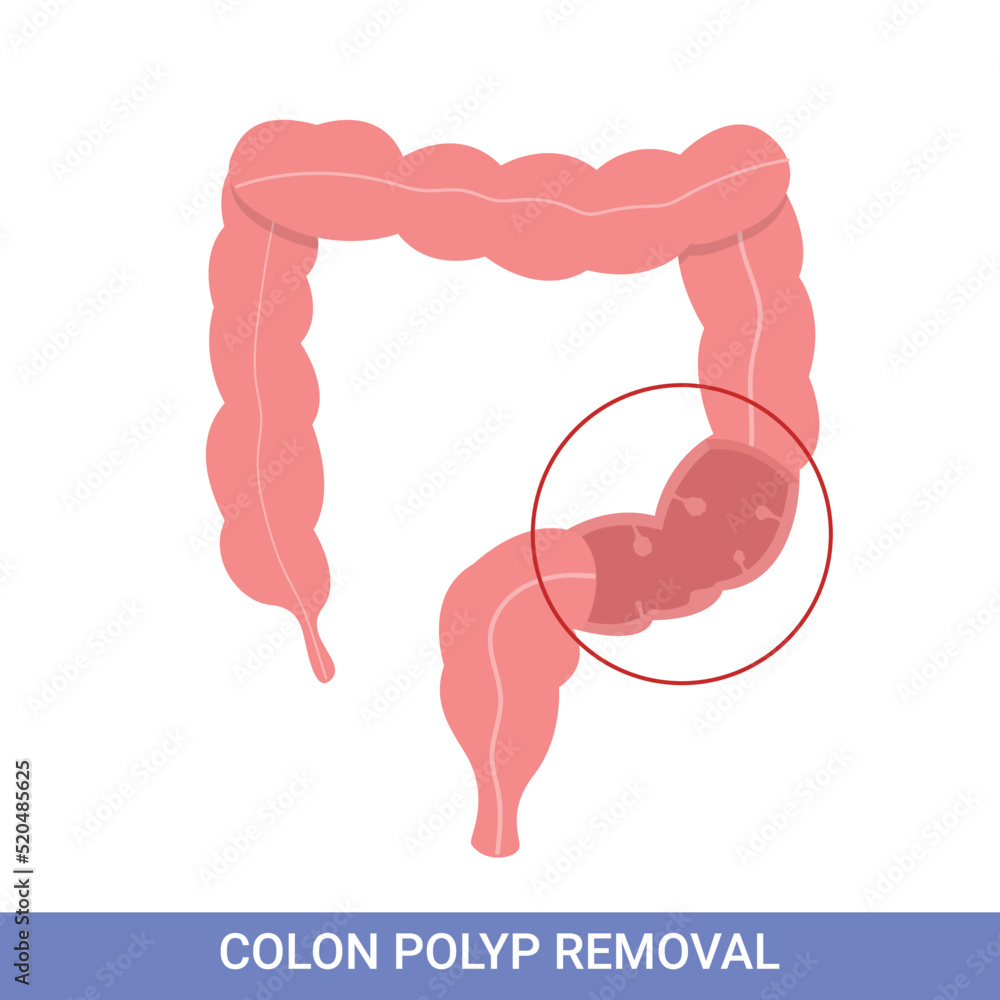 Colonoscopy intestine, polypectomy procedure, removal polyp in colon ...