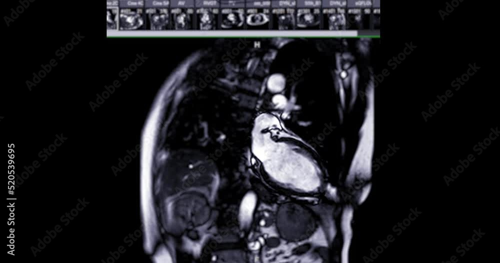 MRI heart or Cardiac MRI ( magnetic resonance imaging ) of heart ...