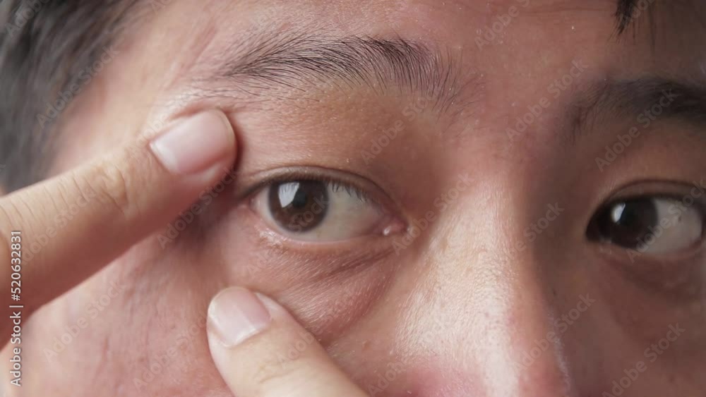 Video „Asian men have dry eyes. concept of eye disease Eye health check ...