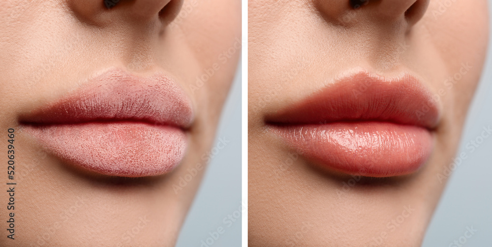Collage with photos of woman with dry and moisturized lips, closeup ...