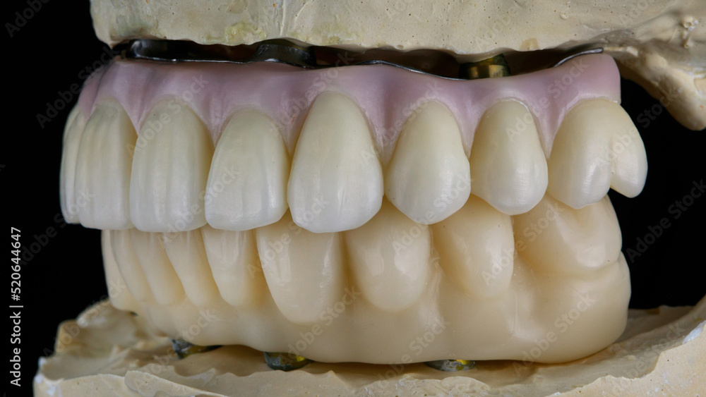 Dental model with dentures from zircon of the upper jaw and temporary ...