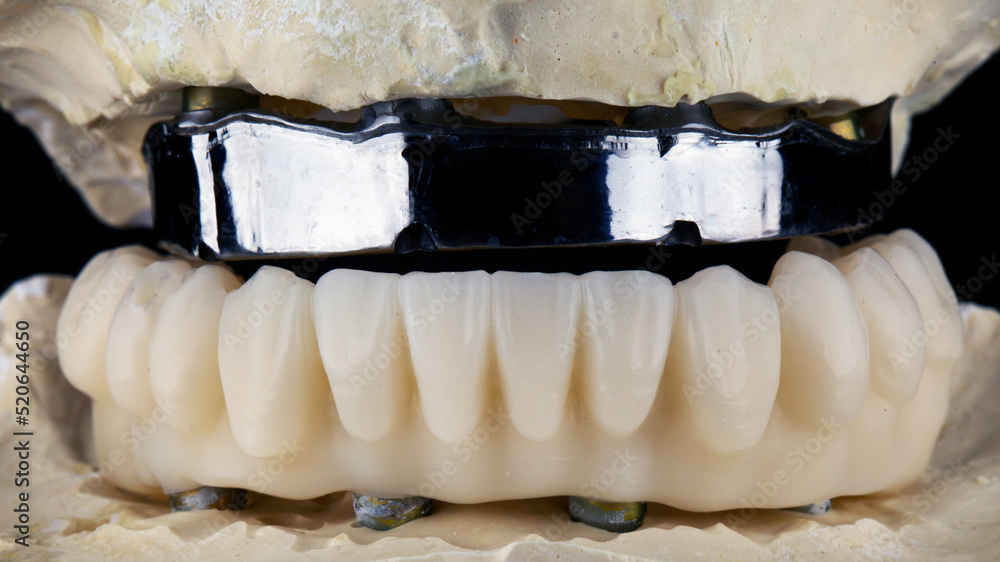 Dental model with a titanium beam and temporary prosthesis of the lower ...