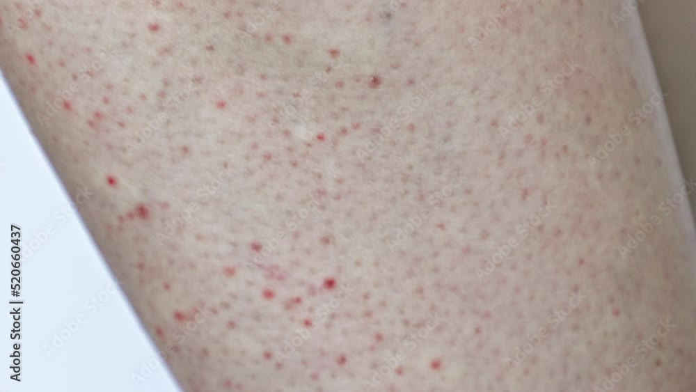 Stockvideo Close-up of the leg skin covered with red rash, pimples and ...