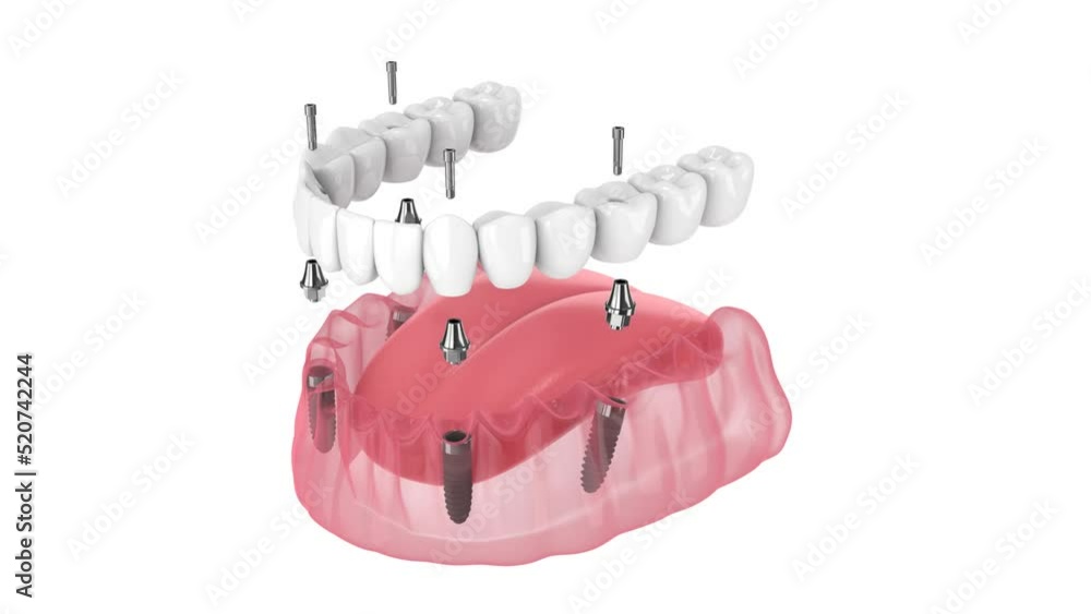 Dental prosthesis all-on-4 system supported by implants Stock Video ...