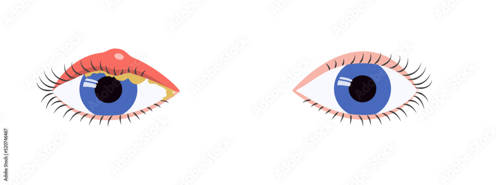 Blue eyes comparison of healthy state and blepharitis symptoms ...