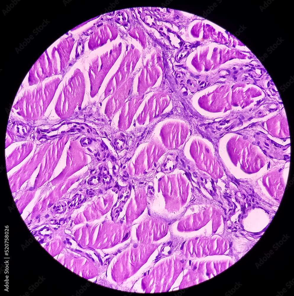 Vascular tumor of scalp biopsy: Intramuscular hemangioma, benign tumor ...