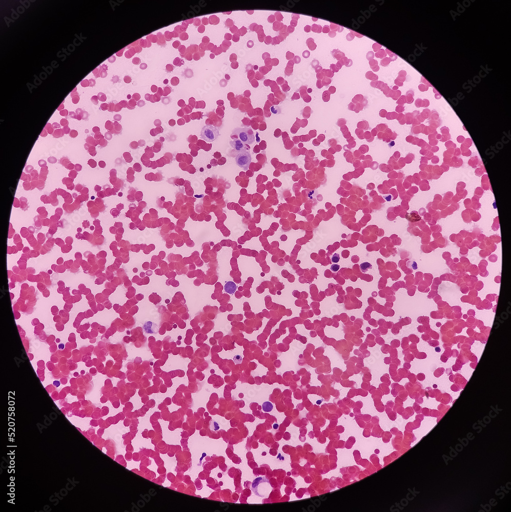 Microscopic image of breast stromal sarcoma. Malignant cell positive ...