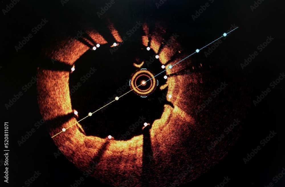 Intravascular imaging Optical Coherence Tomography (OCT) after deployed ...