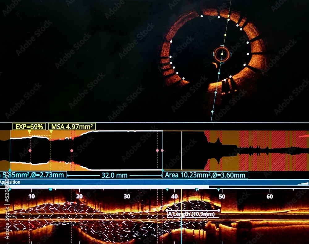 Intravascular imaging Optical Coherence Tomography (OCT) after deployed ...
