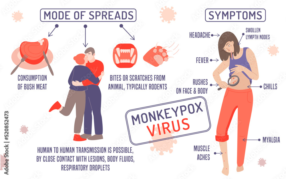 Monkeypox virus infographics. Symptoms and useful information. Stock ...
