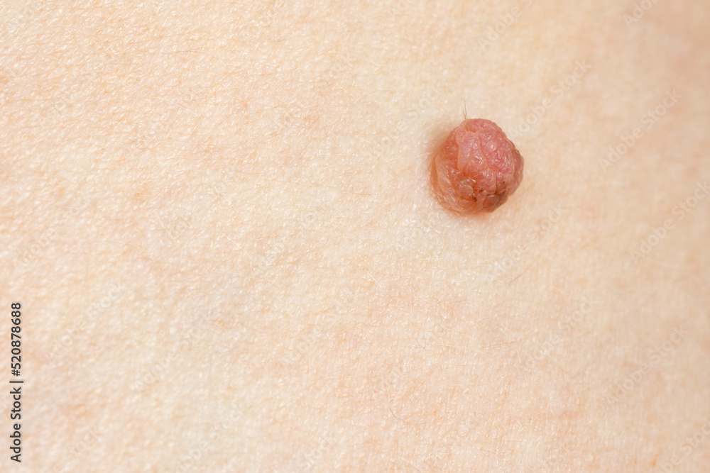Macro close ups of moles on caucasian skin with a shallow depth of ...