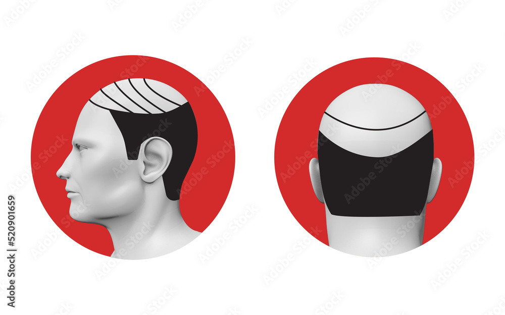 hair transplant and male baldness types - norwood scale, bald stage ...