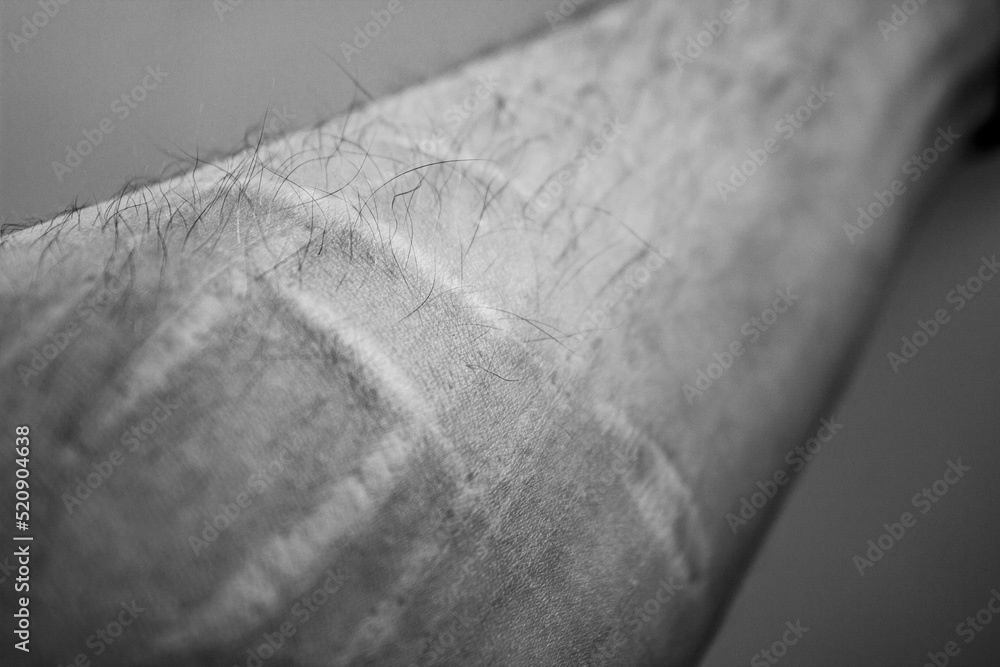 Fotografia do Stock: Scars from cuts on the arm. suicide.Cut marks on ...