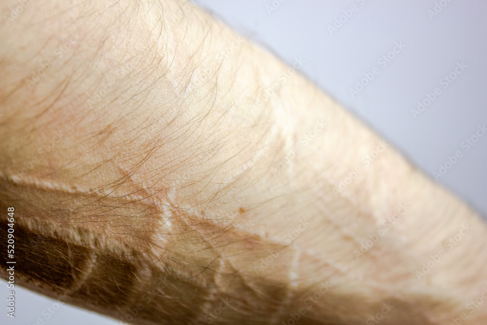 Scars from cuts on the arm. suicide.Cut marks on arms. Stock Photo ...