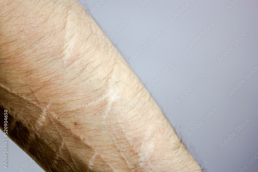 Scars from cuts on the arm. suicide.Cut marks on arms. Stock Photo ...