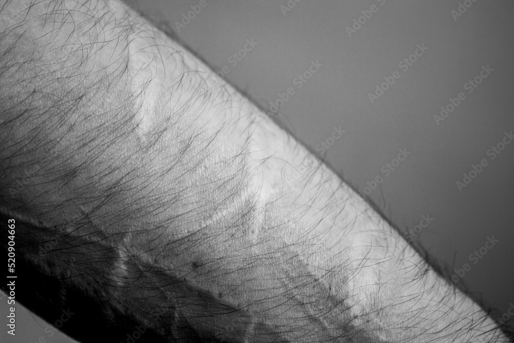Cuts On Arms Black And White