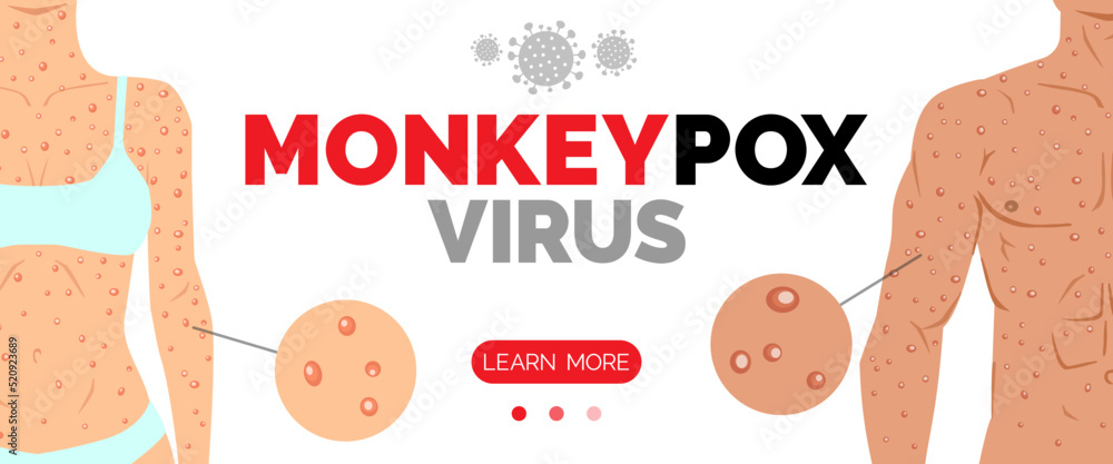 monkeypox virus outbreak female and male body torso rash vector ...