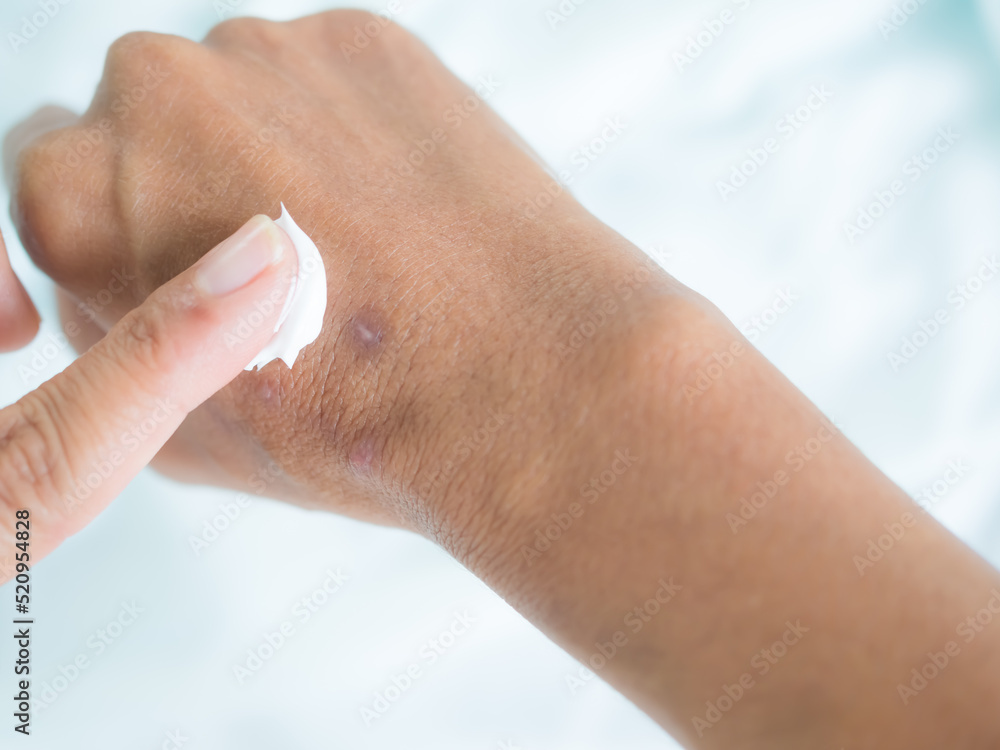 Scar on hand woman. finger applying removal blister wound on skin body ...