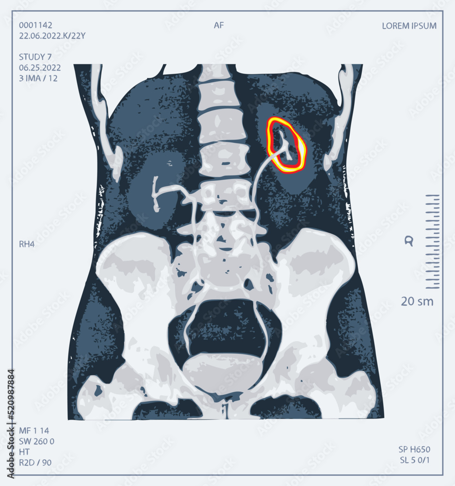 vector x-ray of human abdomen with pelvic bone and spine. Medical ...