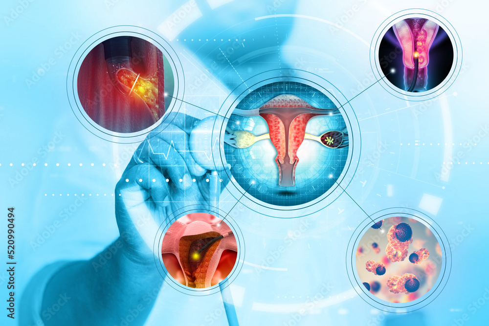 Doctor check and diagnose the female reproductive system diseases. Uterus cancer and endometrial ...