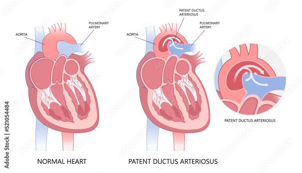 Póster patent ductus arteriosus of pulmonary arteries – Cuadro para Pared | Posters.es