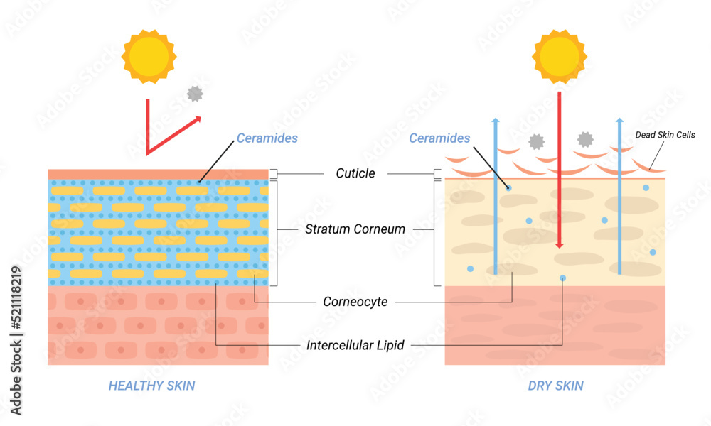 Dry and healthy skin layer illustration. beauty and skin care concept ...
