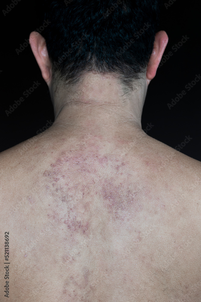 Texture red rash on back man Stock Photo | Adobe Stock