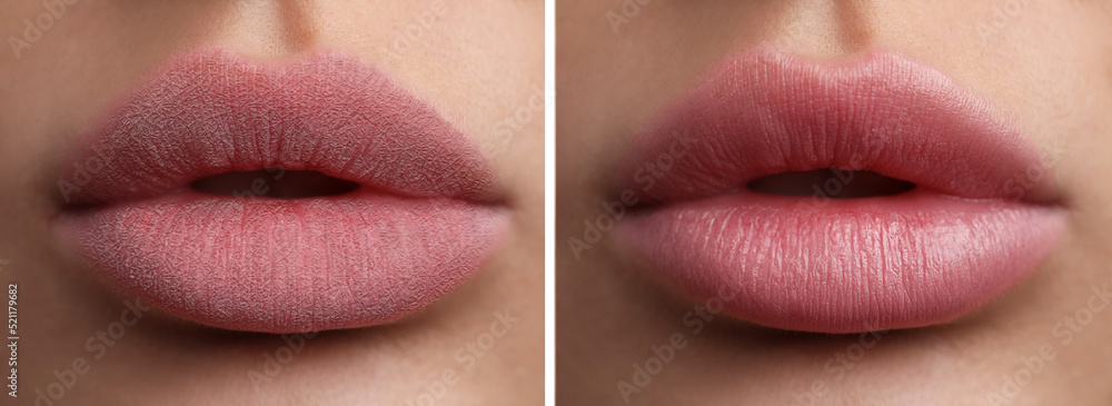 Collage with photos of woman with dry and moisturized lips, closeup ...