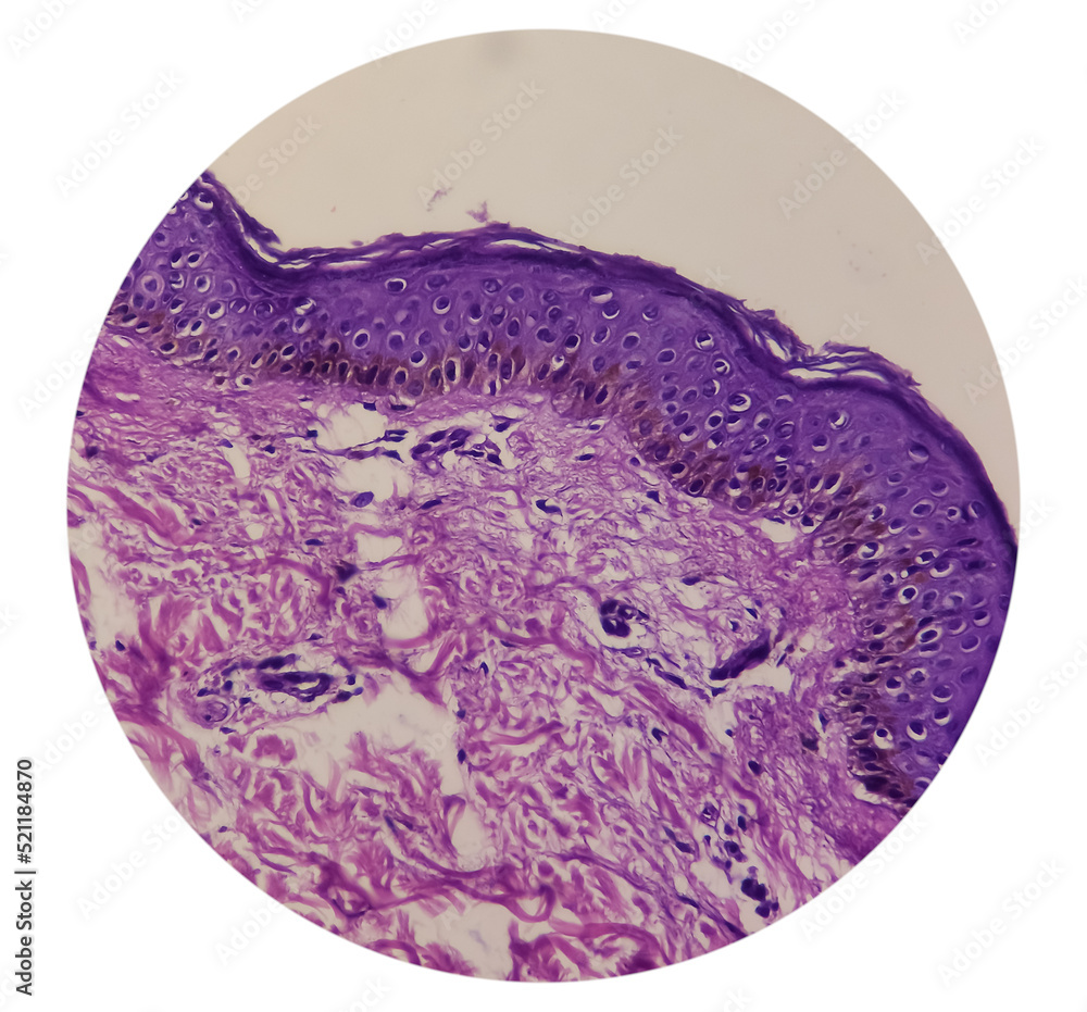 Abduminal wall skin tissue histology. Ashy dermatosis, show basal ...