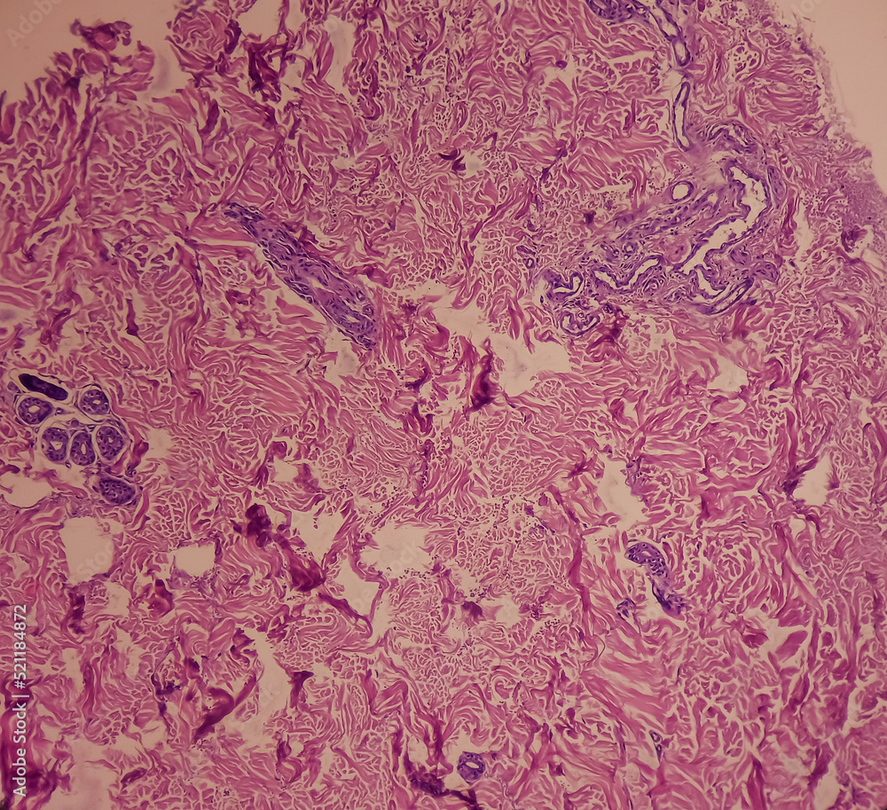 Abduminal wall skin tissue histology. Ashy dermatosis, show basal ...