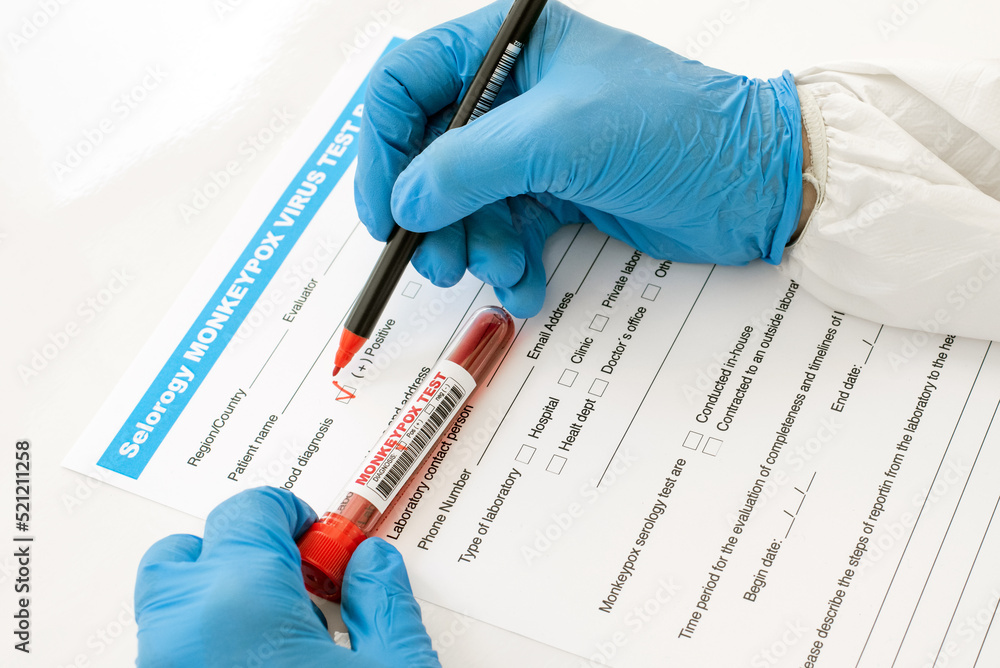 doctor in nitrile gloves fill out blood test form for monkeypox with ...