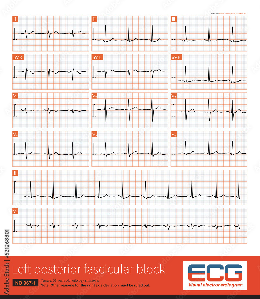 During left posterior fascicular block, the ECG showed right axis ...