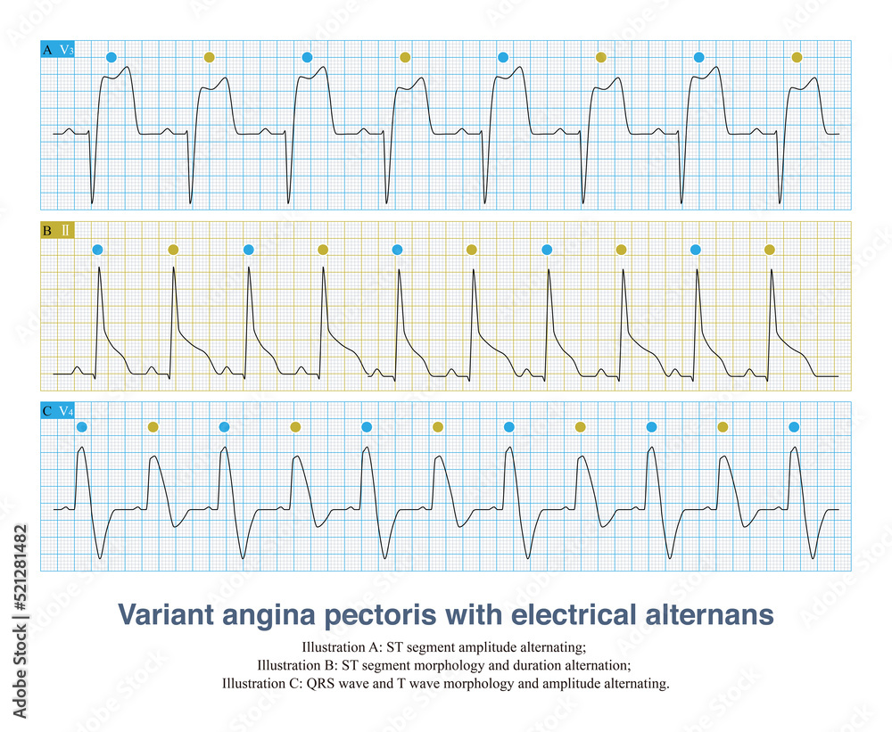 Plakát During acute transmural myocardial ischemia, the repolarization ...