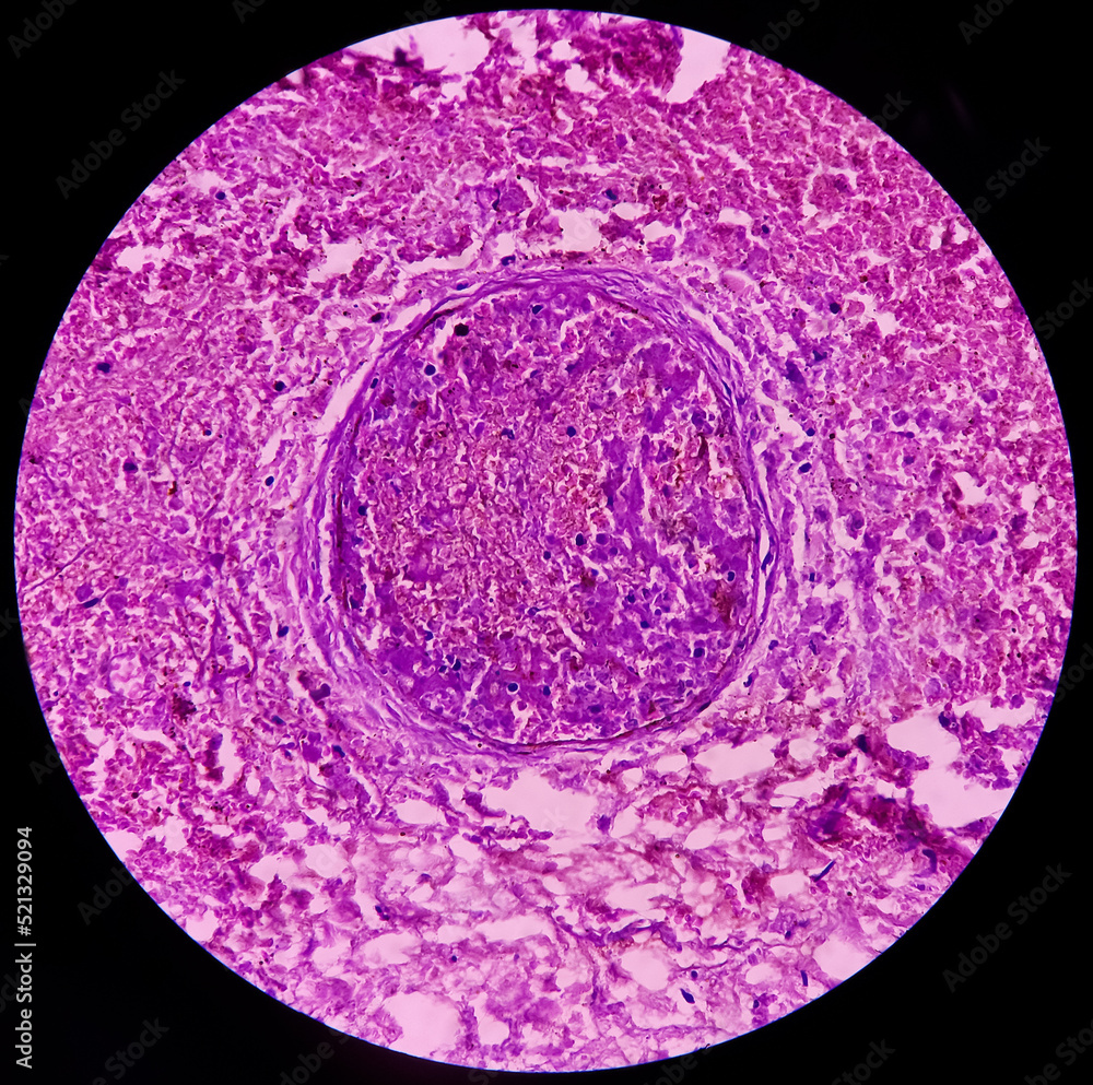 Fotografia do Stock: Dermoid cyst, Mature cystic teratoma, show skin ...