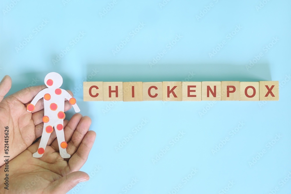 Chickenpox disease infection outbreak care, prevention and protection ...