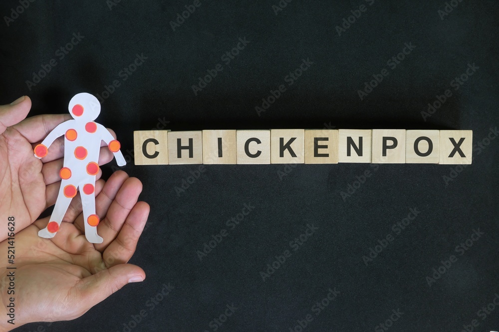 Chickenpox disease infection outbreak care, prevention and protection ...