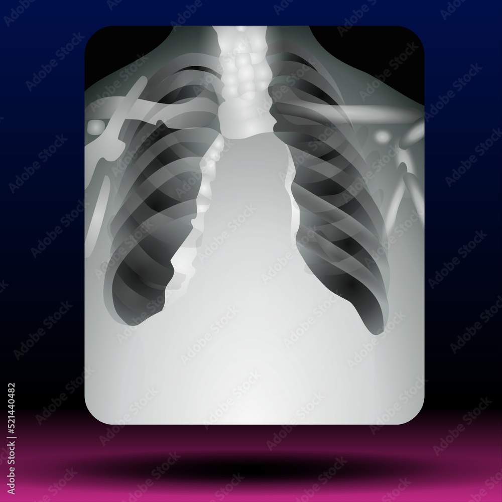 Chest X-Ray, Science, Medical, Ribs, Scapula, Anatomy, healthcare ...