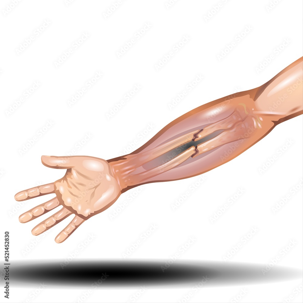 Hand Bone Fracture - Distal radius fracture and broken arm bone types ...