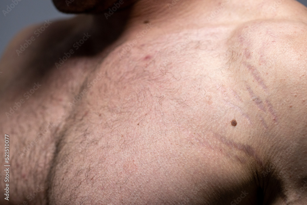 stretch marks on the arm. striae distensae Stock Photo | Adobe Stock