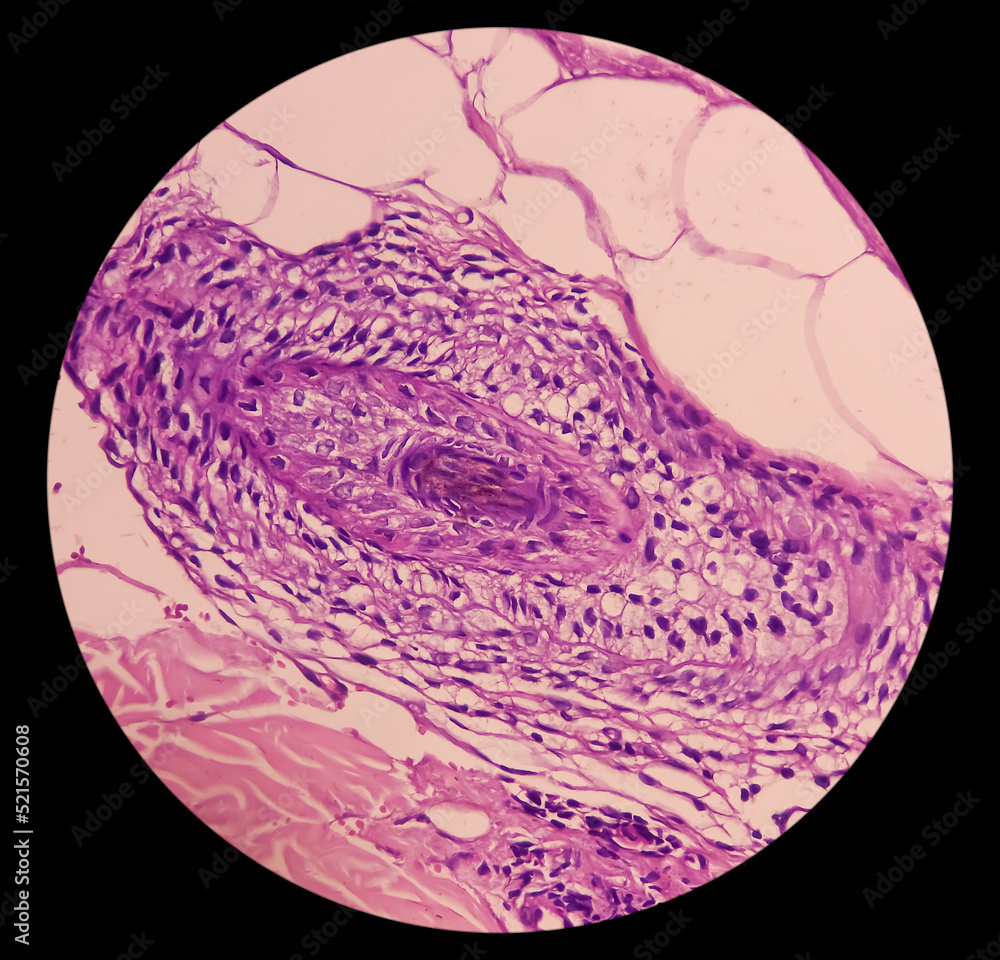 Microscopic image of back skin tissue, Pemphigus vulgaris, smear show ...