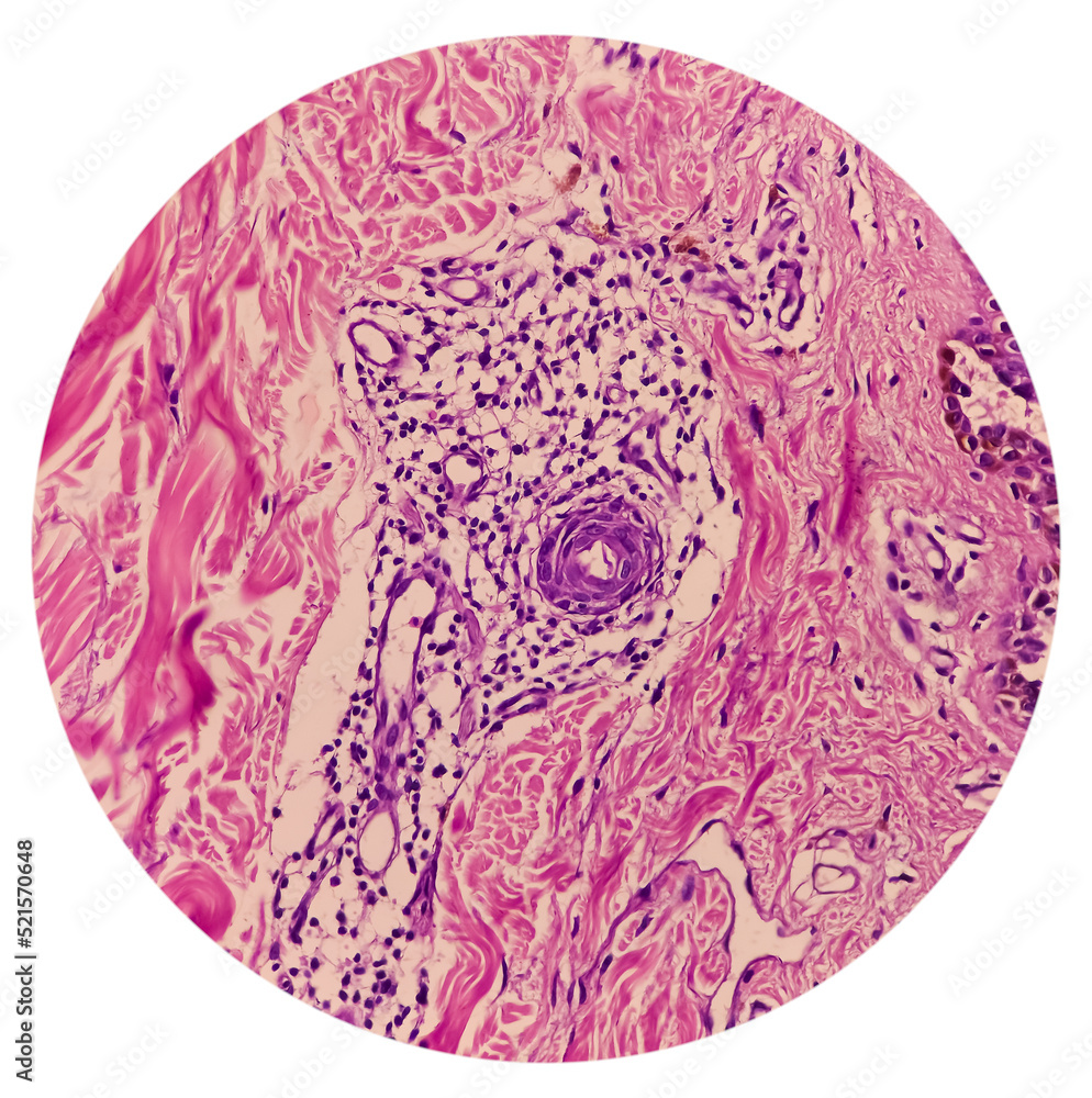 Microscopic image of back skin tissue, Pemphigus vulgaris, smear show ...