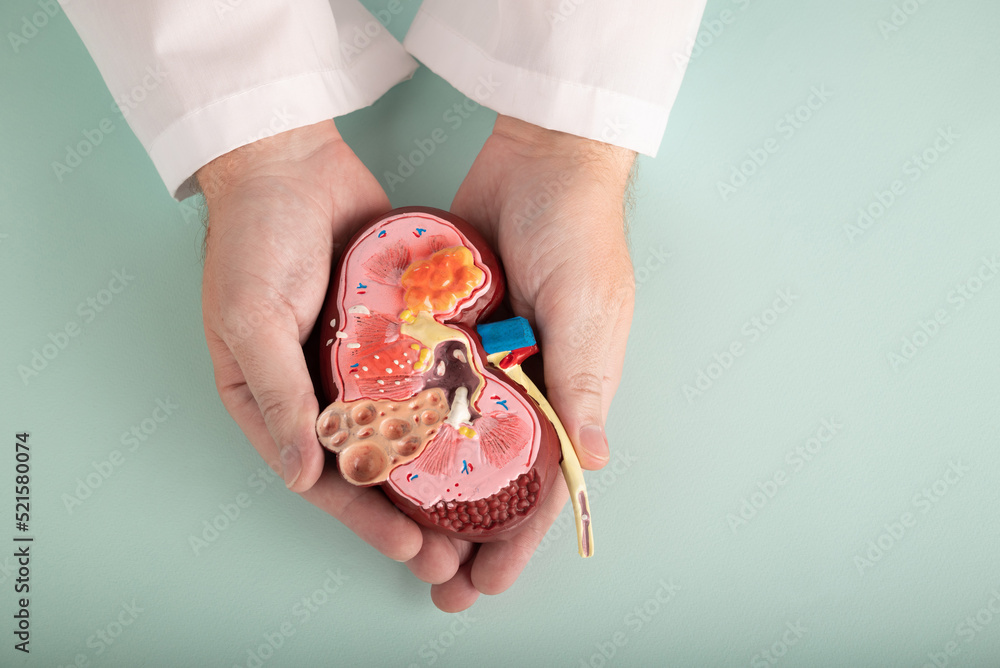The model of a diseased kidney in doctor palm hand on blue background ...